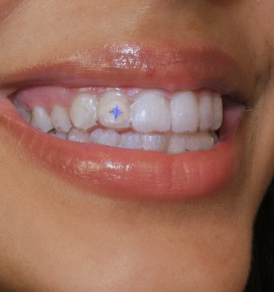 Invsialign Stickables™ Stickers | Invisalign Accessory Store